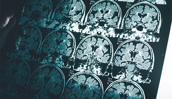 Crucial Knowledge: The Importance of Brain Donation